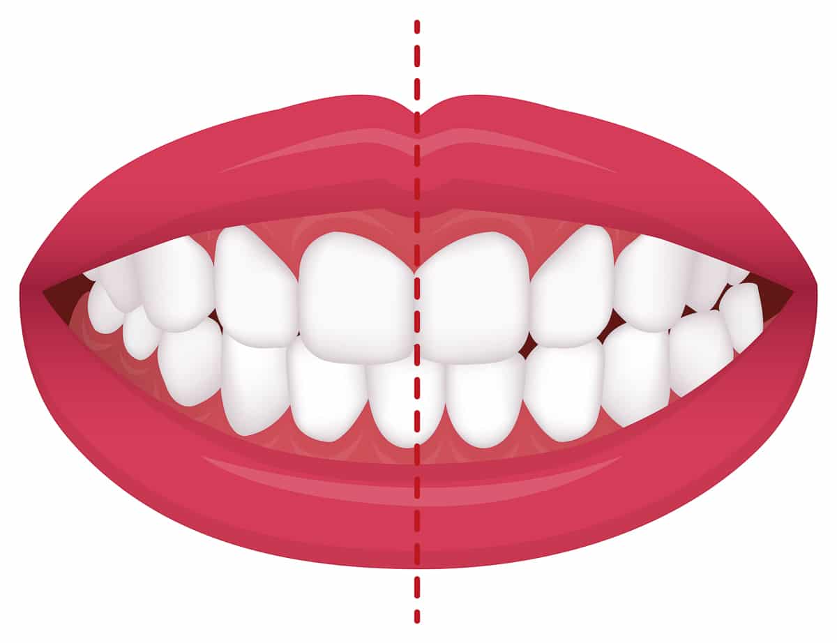 Traitement de l'occlusion croisée : toutes les infos sur la correction ...