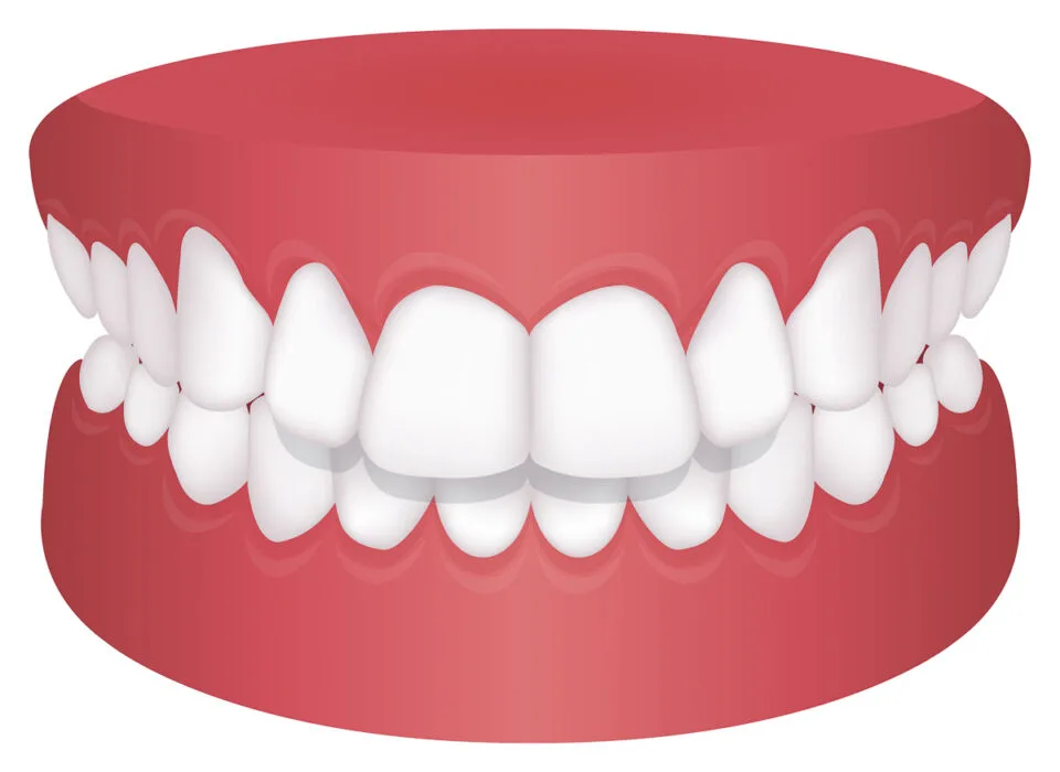 Tratamiento de la sobremordida: Toda la información sobre la corrección ...