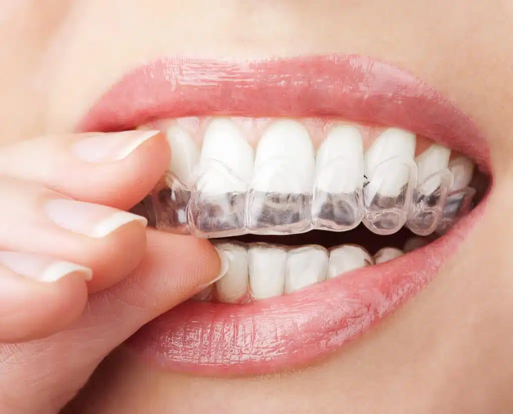Invisalign i7: tooth correction for slight malocclusions