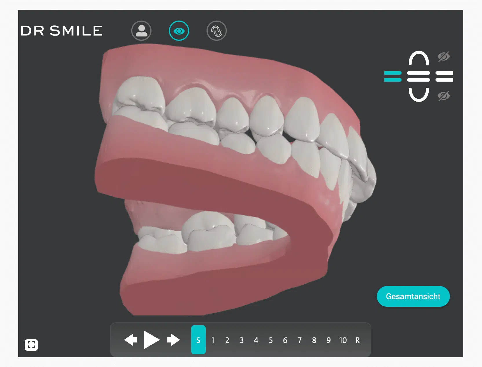 DrSmile Behandlungsplan mit 3D-Simulation - so sieht er aus